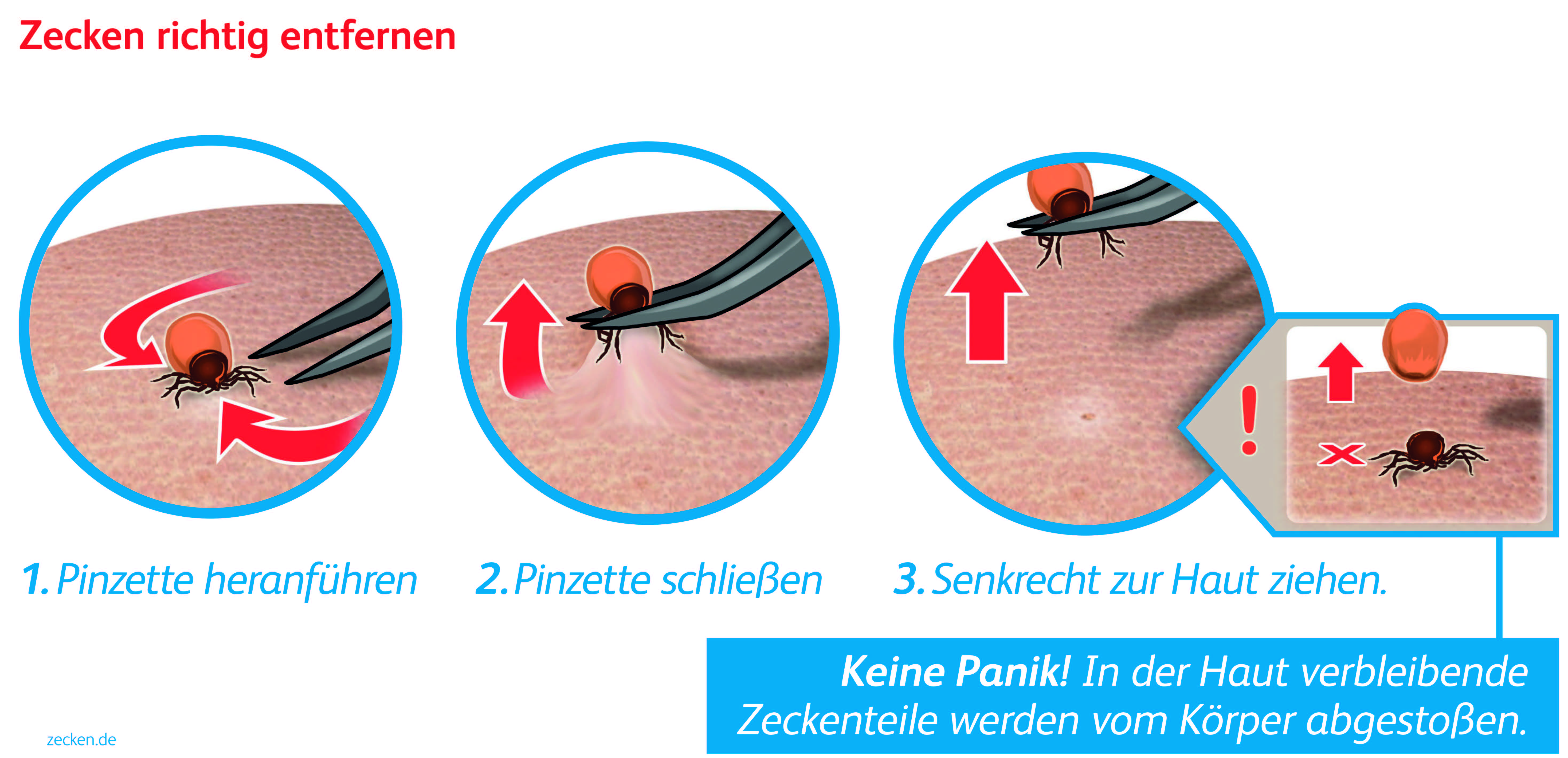 Erstaunlich Zecke Entfernen Mit L Fotos